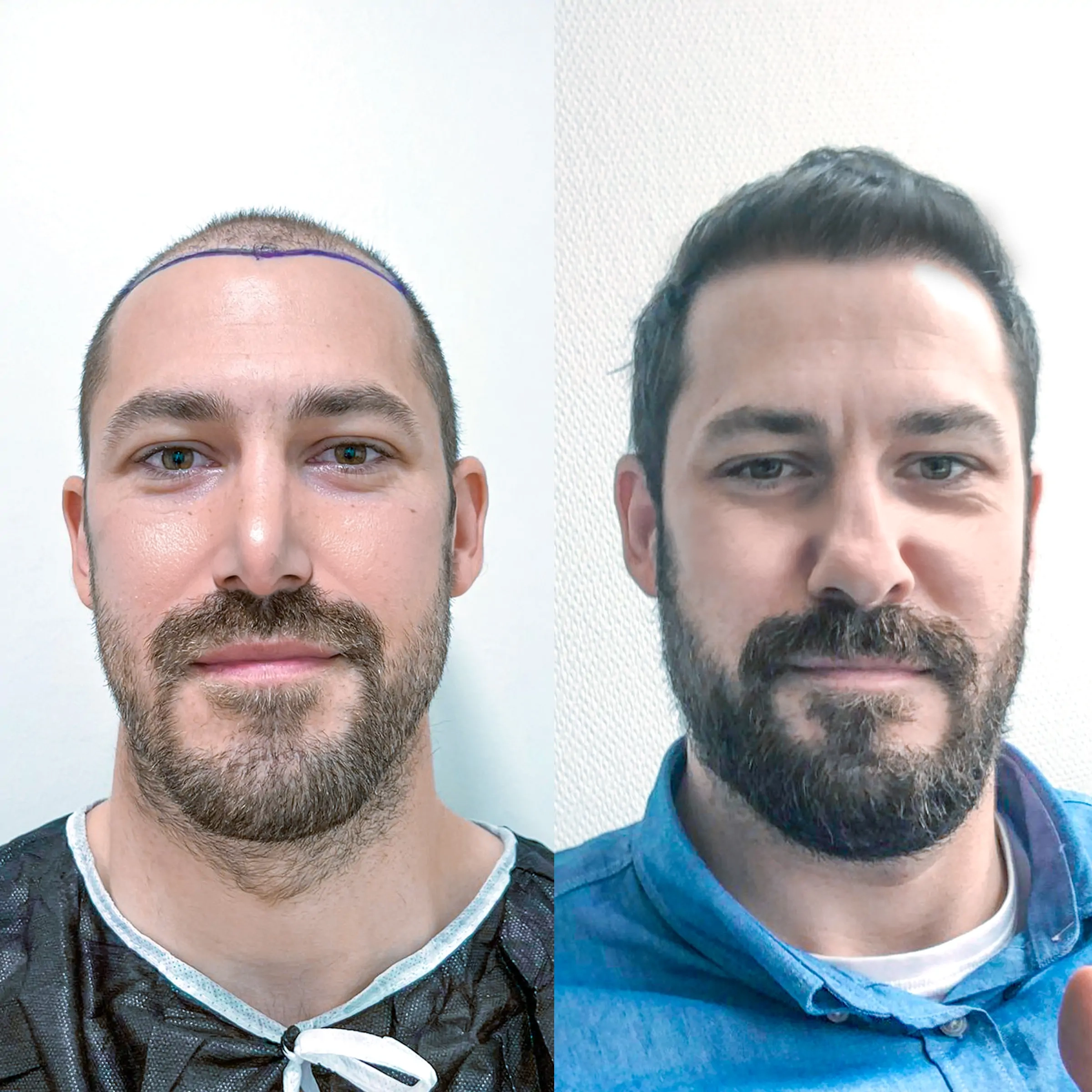 Hair Transplant in Turkey | Hermest Clinic Airport – Hair Transplant in ...