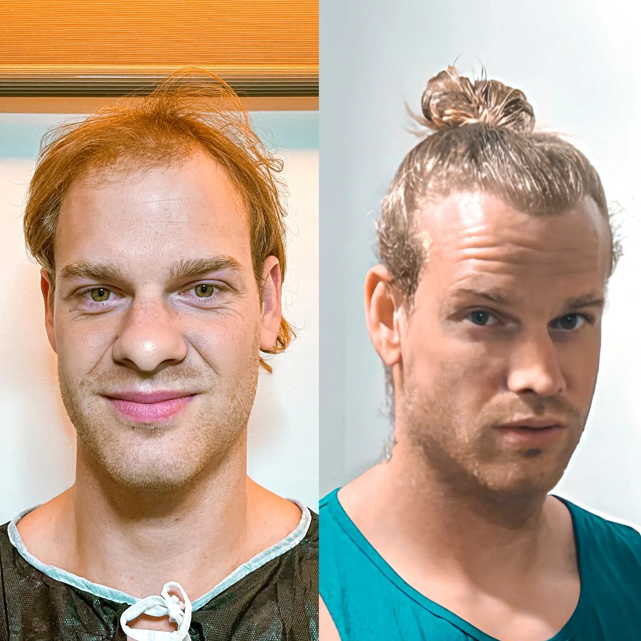 Hair Transplant in Turkey | Hermest Clinic Airport – Hair Transplant in ...