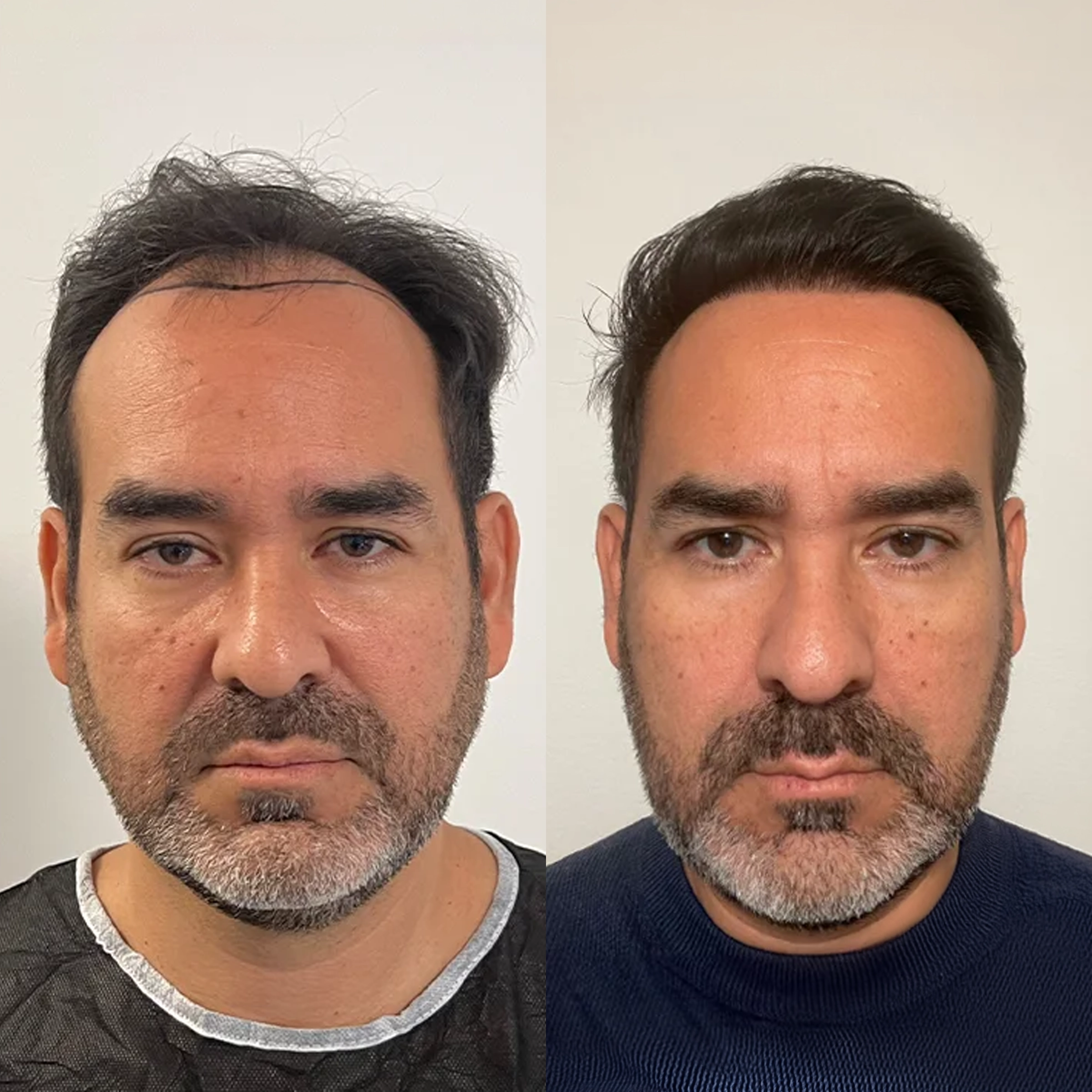 Hair Transplant in Turkey | Hermest Clinic Airport – Hair Transplant in ...